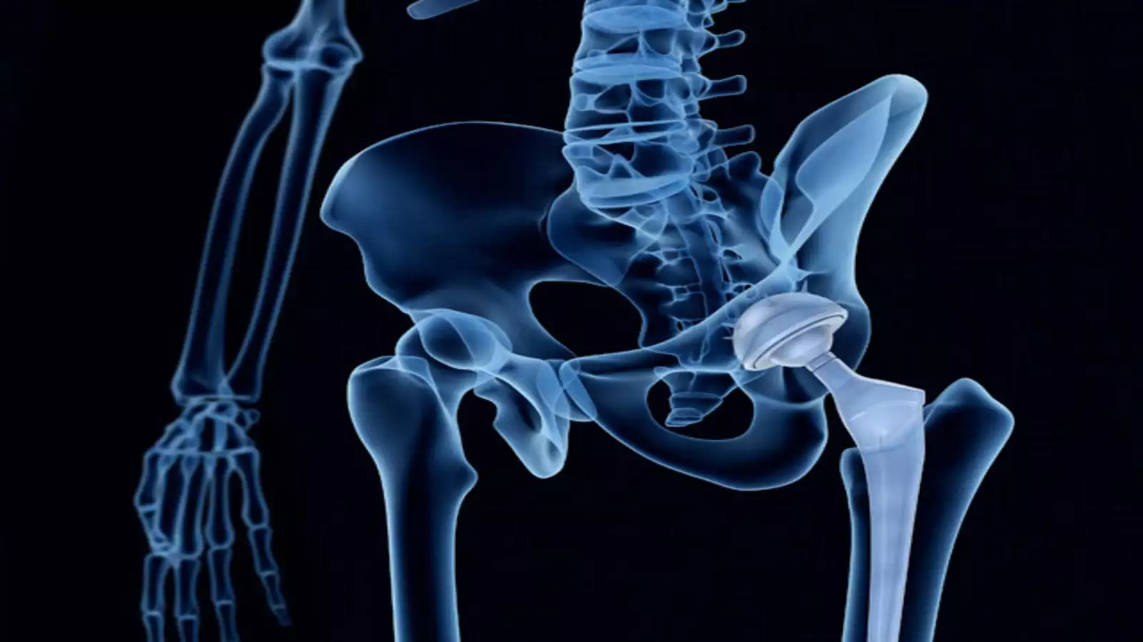 Mastering Orthopaedic implants - Orthopaedic Academy